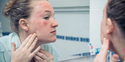 Drinking A Margarita This Summer Could Give You A Horrible Skin Rash ...